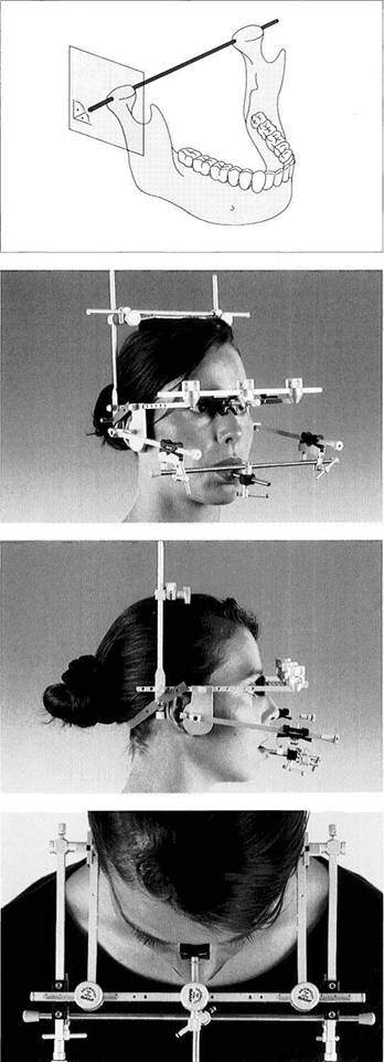 Instrumented Analysis of Jaw Movements Dental
